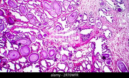 Histopathology of prostate gland hyperplasia, light micrograph, photo ...