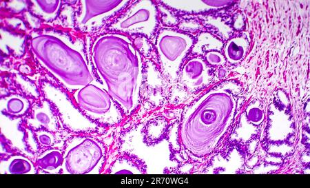 Histopathology of prostate gland hyperplasia, light micrograph, photo ...