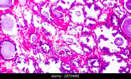 Histopathology of prostate gland hyperplasia, light micrograph, photo ...