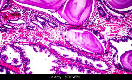 Histopathology of prostate gland hyperplasia, light micrograph, photo ...