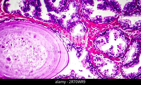 Histopathology of prostate gland hyperplasia, light micrograph, photo ...