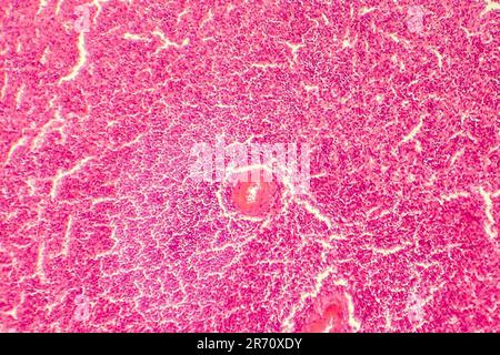 Hyaline degeneration of splenic artery, light photomicrograph Stock ...