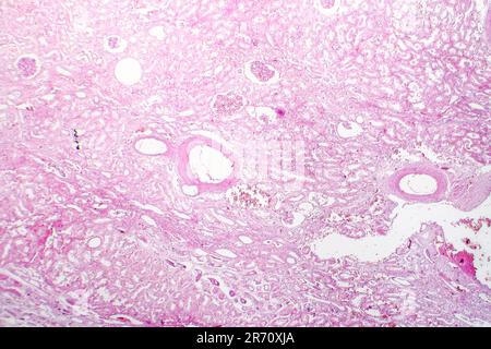 Tubular epithelial edema, light micrograph, photo under microscope ...