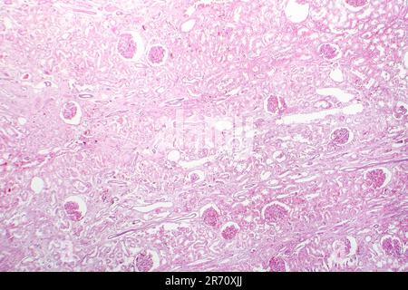 Tubular epithelial edema, light micrograph, photo under microscope ...