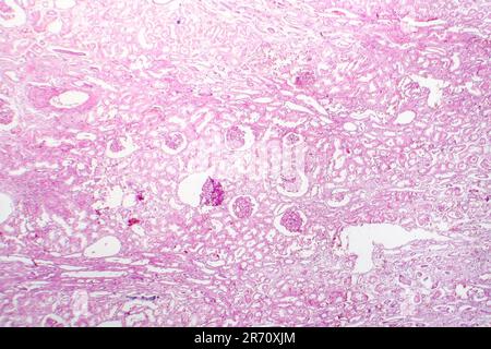 Tubular epithelial edema, light micrograph, photo under microscope ...