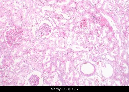 Tubular epithelial edema, light micrograph, photo under microscope ...