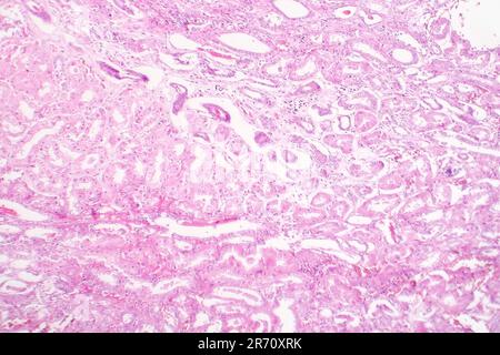 Tubular epithelial edema, light micrograph, photo under microscope ...