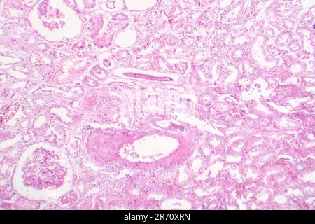 Tubular epithelial edema, light micrograph, photo under microscope ...