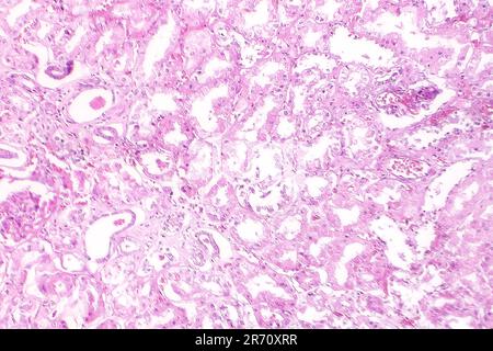 Tubular epithelial edema, light micrograph, photo under microscope ...