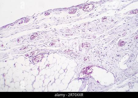 Granulomatous inflammation, light micrograph, photo under microscope ...