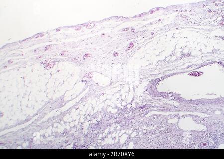 Granulomatous inflammation, light micrograph, photo under microscope ...