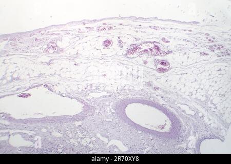 Granulomatous inflammation, light micrograph, photo under microscope ...