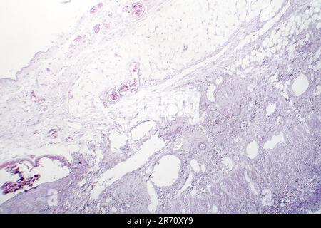Granulomatous inflammation, light micrograph, photo under microscope ...