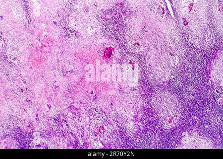 Caseous necrosis of lymphatic node, light micrograph, photo under ...