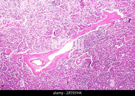 Splenic arterioles hyalinization, light micrograph, hematoxylin and ...
