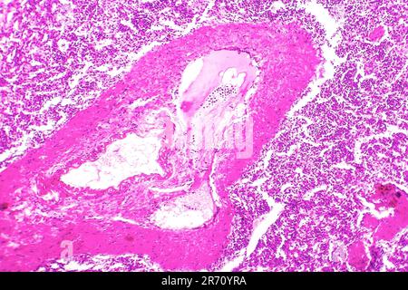 Splenic arterioles hyalinization, light micrograph, hematoxylin and ...