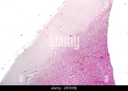 Splenic capsule hyaline degeneration, light micrograph, photo under ...