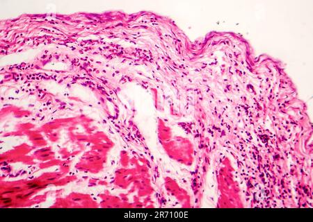 Signet ring cell carcinoma of the stomach, light micrograph, photo ...