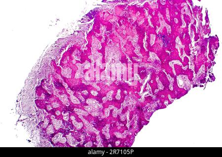 Histology of callus, a thickened skin made as a result of pressure ...