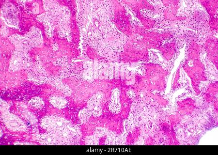 Histology of callus, a thickened skin made as a result of pressure ...