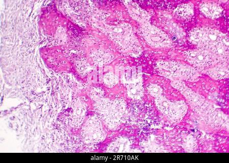 Histology of callus, a thickened skin made as a result of pressure ...