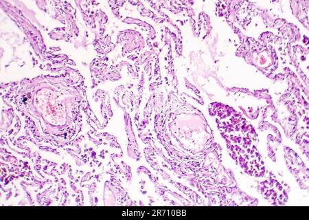 Chronic pulmonary congestion, light micrograph. Photo under microscope ...