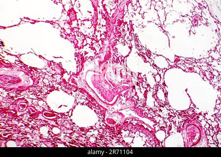 Transparent thrombosis, light micrograph, hematoxylin and eosin ...