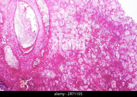 Histopathology of pulmonary hemorrhagic infarct, light micrograph Stock ...