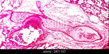 Transparent thrombosis, light micrograph, hematoxylin and eosin ...