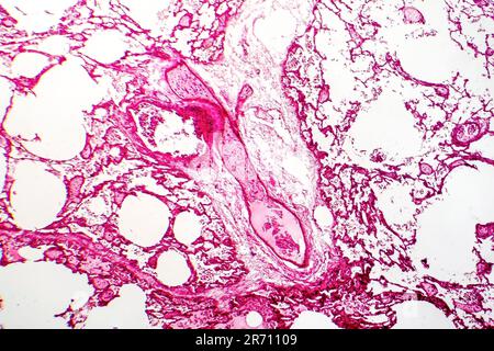 Transparent thrombosis, light micrograph, hematoxylin and eosin ...