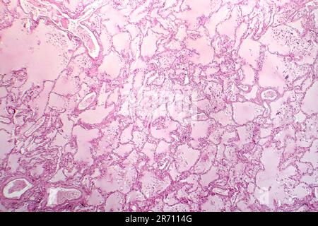 Histopathology of acute pulmonary edema, light micrograph showing ...