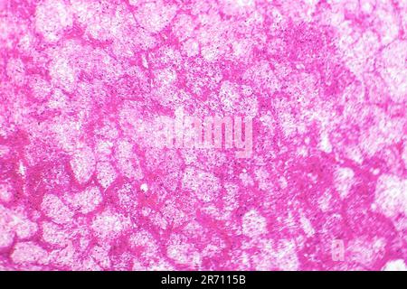 Histopathology of pulmonary hemorrhagic infarct, light micrograph Stock ...