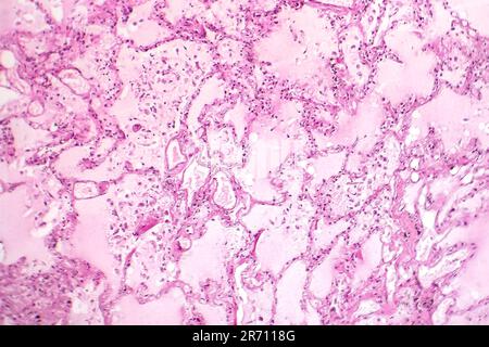 Histopathology of acute pulmonary edema, light micrograph showing ...