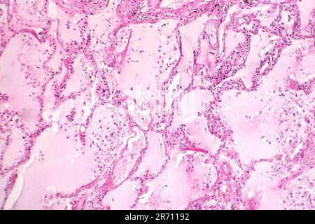 Histopathology of acute pulmonary edema, light micrograph showing ...