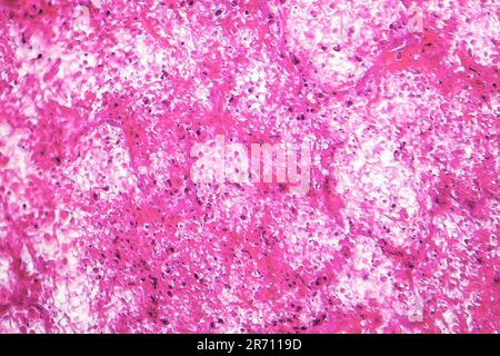 Histopathology of pulmonary hemorrhagic infarct, light micrograph Stock ...