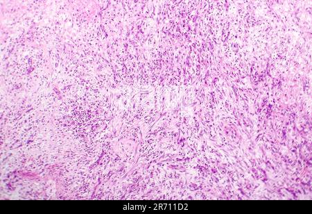Splenic infarction, light micrograph, photo under microscope Stock ...