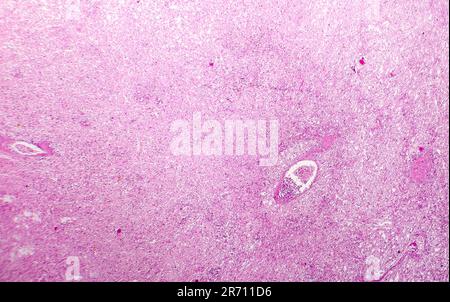 Splenic infarction, light micrograph, photo under microscope Stock ...