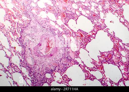 Chronic pulmonary congestion and edema, light micrograph Stock Photo ...