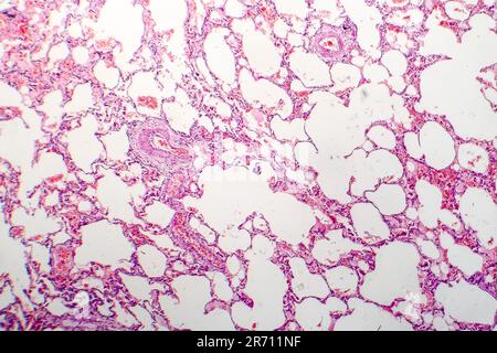 Chronic pulmonary congestion and edema, light micrograph Stock Photo ...