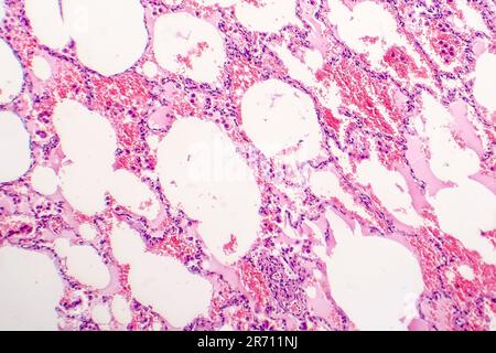 Chronic pulmonary congestion and edema, light micrograph Stock Photo ...