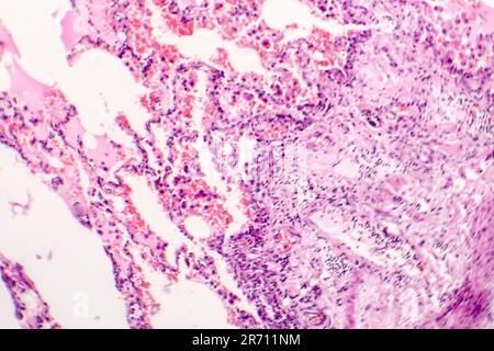 Chronic pulmonary congestion and edema, light micrograph Stock Photo ...