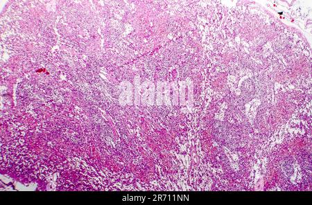 Hemorrhagic lymphadenitits, lymph node inflammation and hemorrhage ...