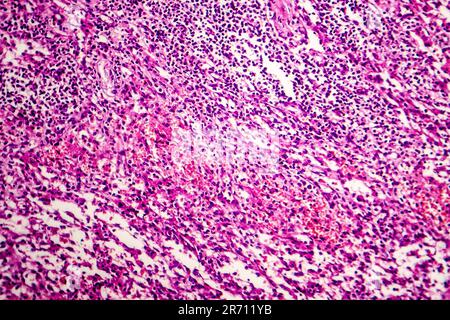 Hemorrhagic lymphadenitits, lymph node inflammation and hemorrhage ...