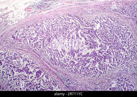 Lymph node cancer, light micrograph, photo under microscope Stock Photo ...