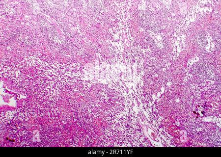 Hemorrhagic lymphadenitits, lymph node inflammation and hemorrhage ...