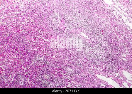 Hemorrhagic lymphadenitits, lymph node inflammation and hemorrhage ...