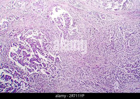Lymph node cancer, light micrograph, photo under microscope Stock Photo ...