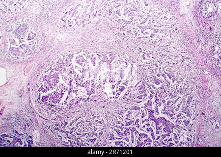 Lymph node cancer, light micrograph, photo under microscope Stock Photo ...