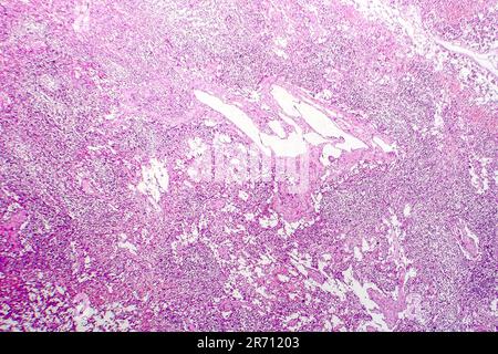 Hemorrhagic lymphadenitits, lymph node inflammation and hemorrhage ...