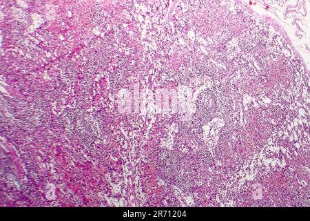 Hemorrhagic lymphadenitits, lymph node inflammation and hemorrhage ...